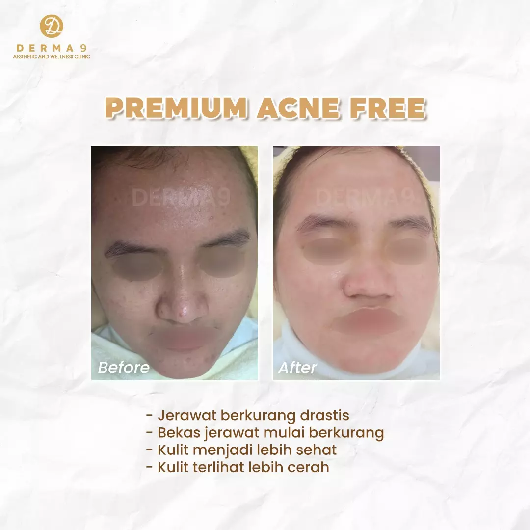 Premium Acne Free - Derma9 Klinik Kecantikan Solo