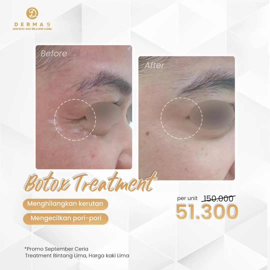 Botox Treatment - Derma9 Klinik Kecantikan Solo